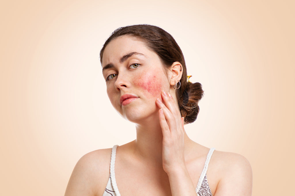 Understanding and Addressing Rosacea | Colorescience